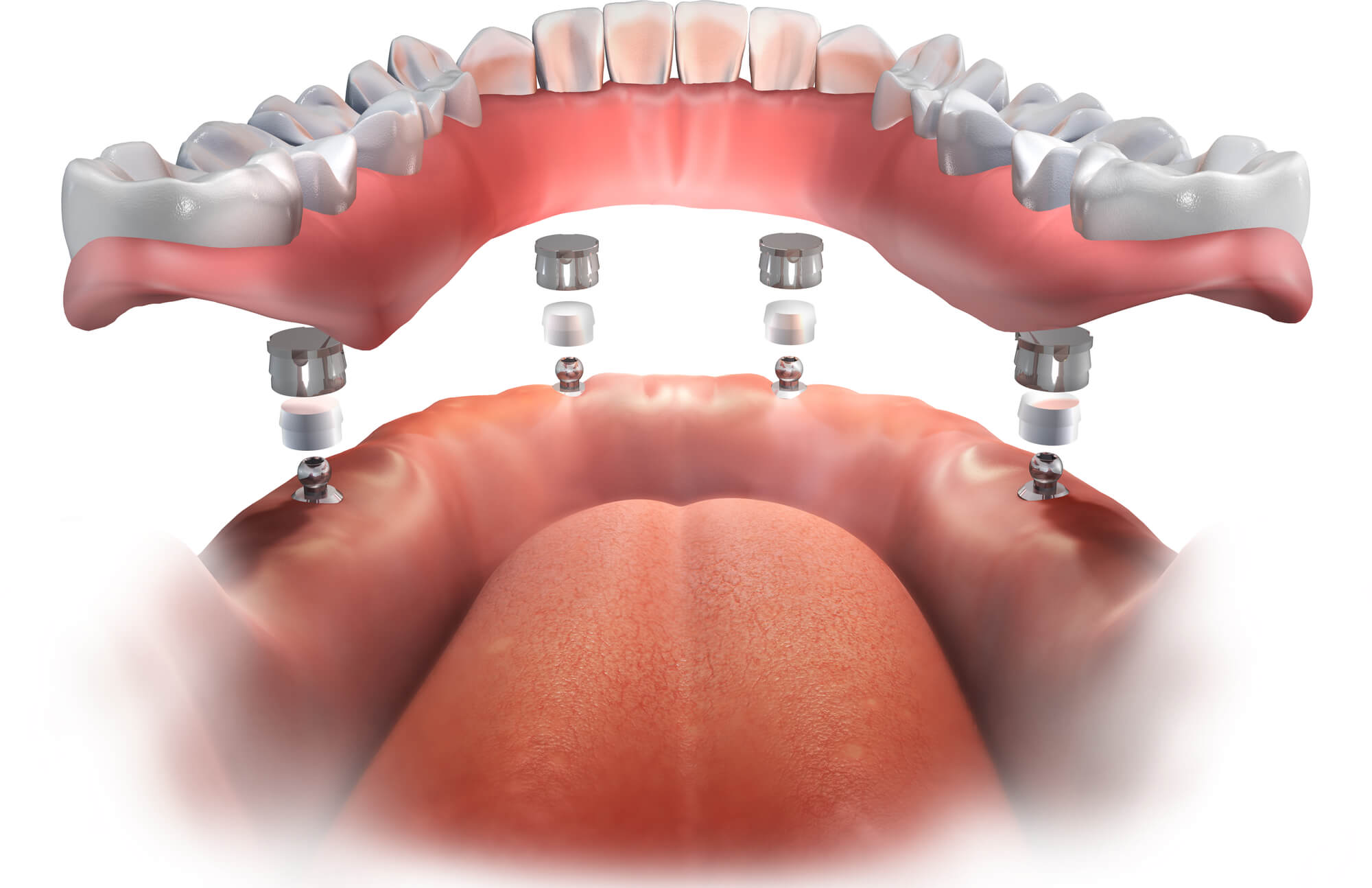 Overdentures: Implant Supported Dentures in Schaumburg, IL | Schaumburg ...